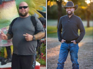 Transoral Outlet Reduction (TORe) | Lonestar Bariatrics