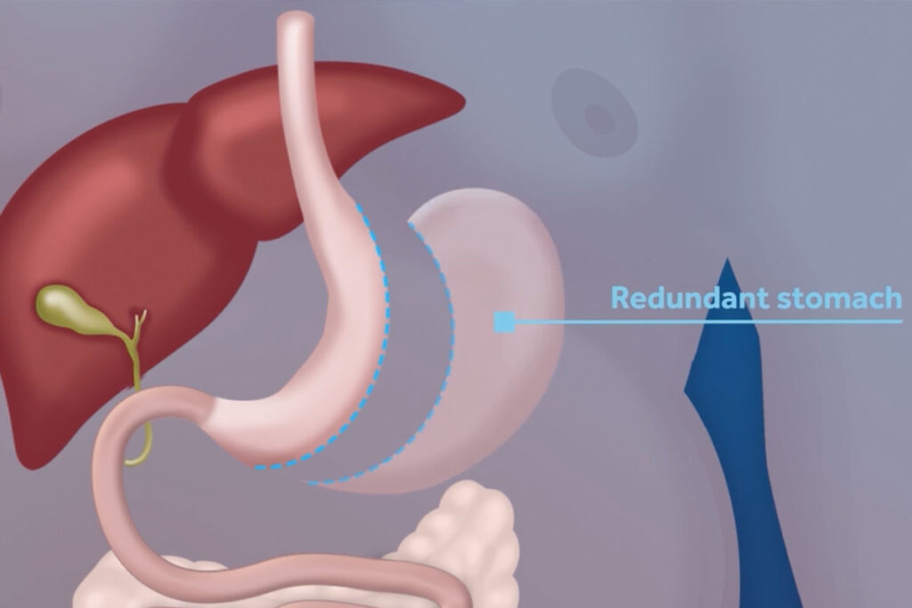 Gastric Sleeve Surgery in Plano, TX | LoneStar Bariatrics