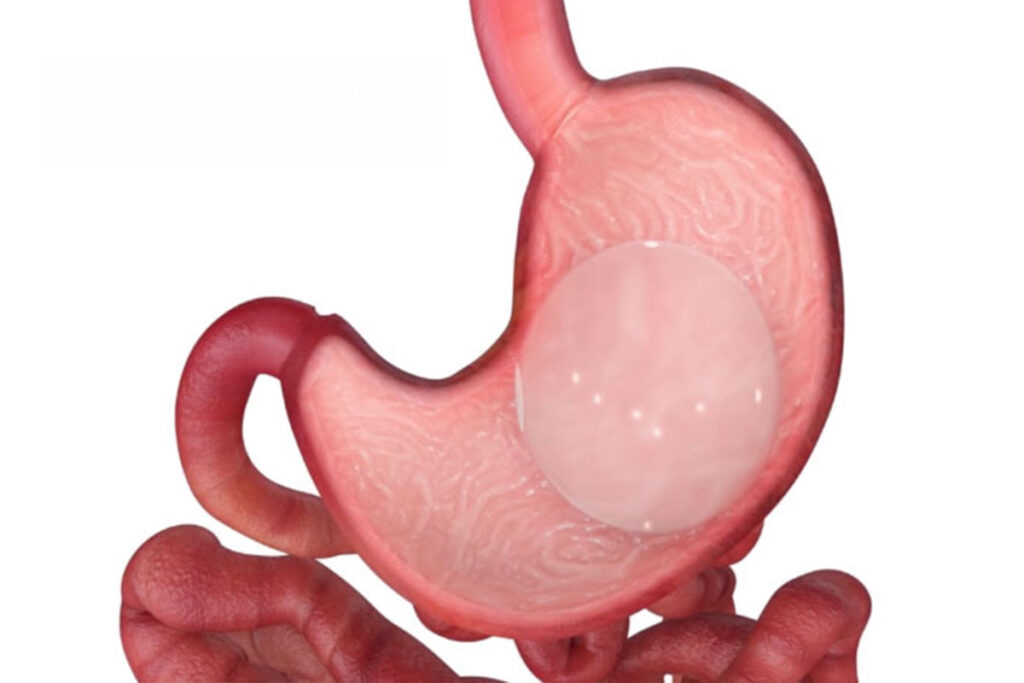 Orbera Gastric Balloon in Plano, TX | LoneStar Bariatrics